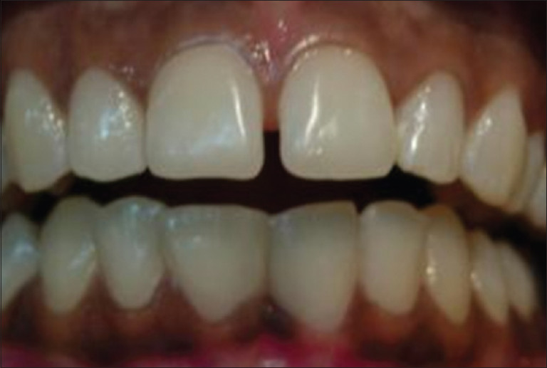 Midline Diastema – Causes and Treatment Options | Omilights